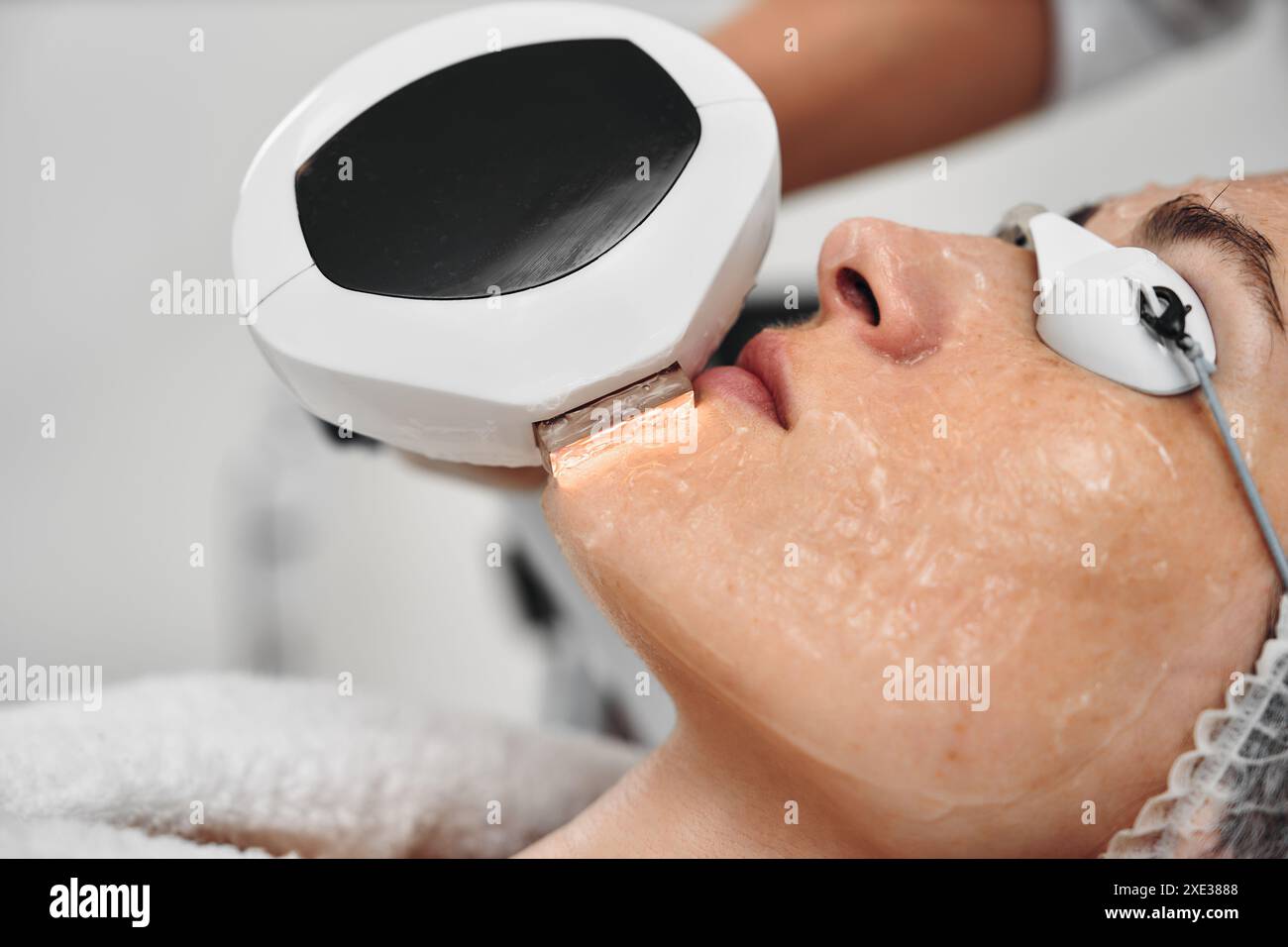 Woman receives ipl therapy hi-res stock photography and images - Alamy