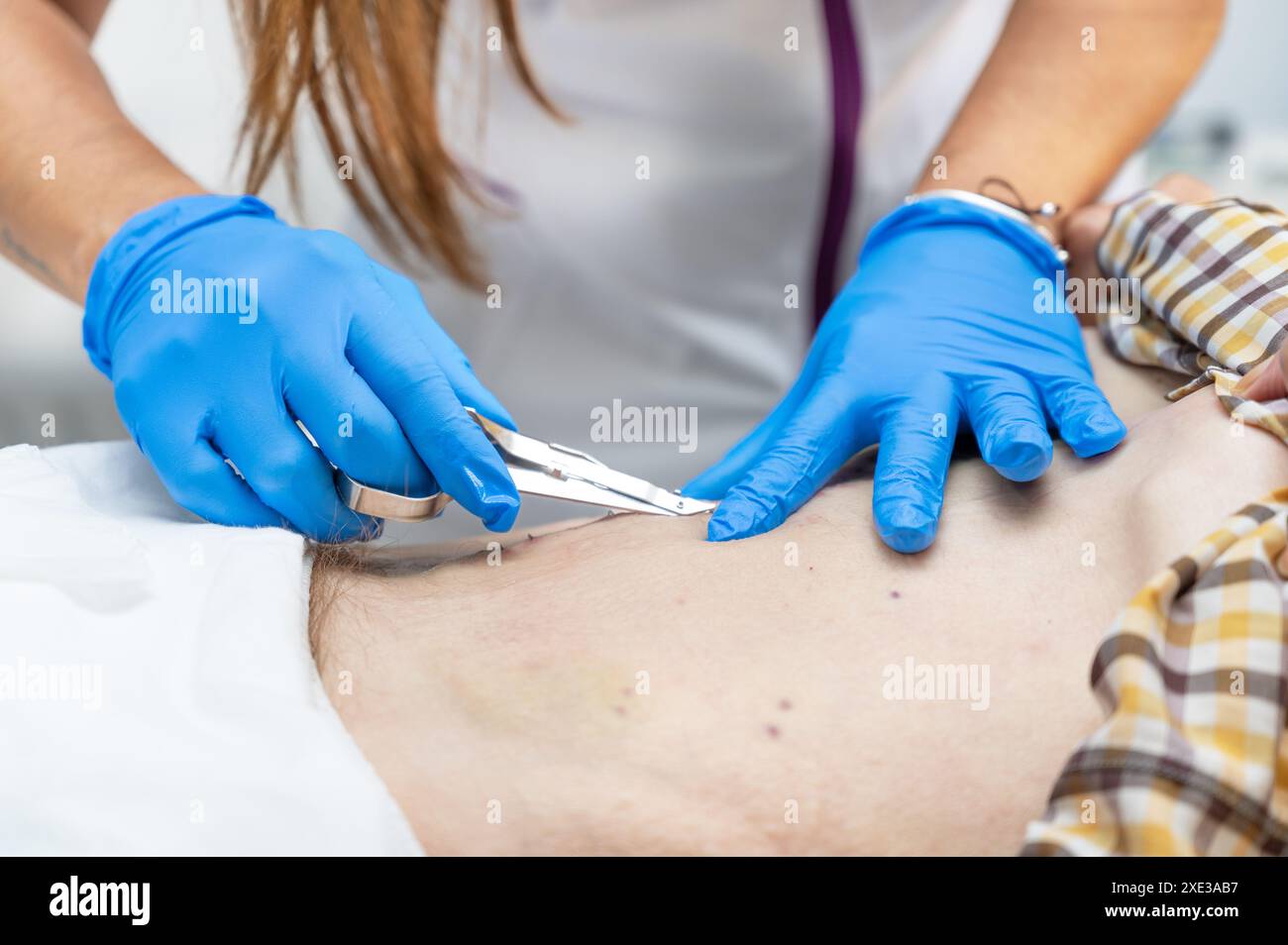 Nurse removing surgical stitches from the abdomen of a patient ...