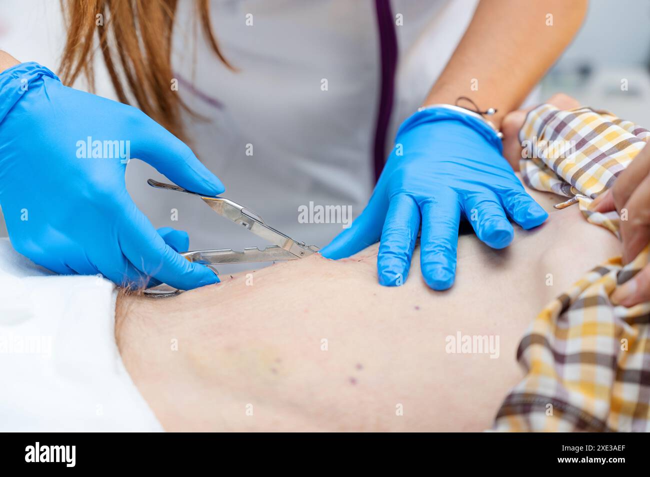 Nurse removing surgical stitches from the abdomen of a patient ...