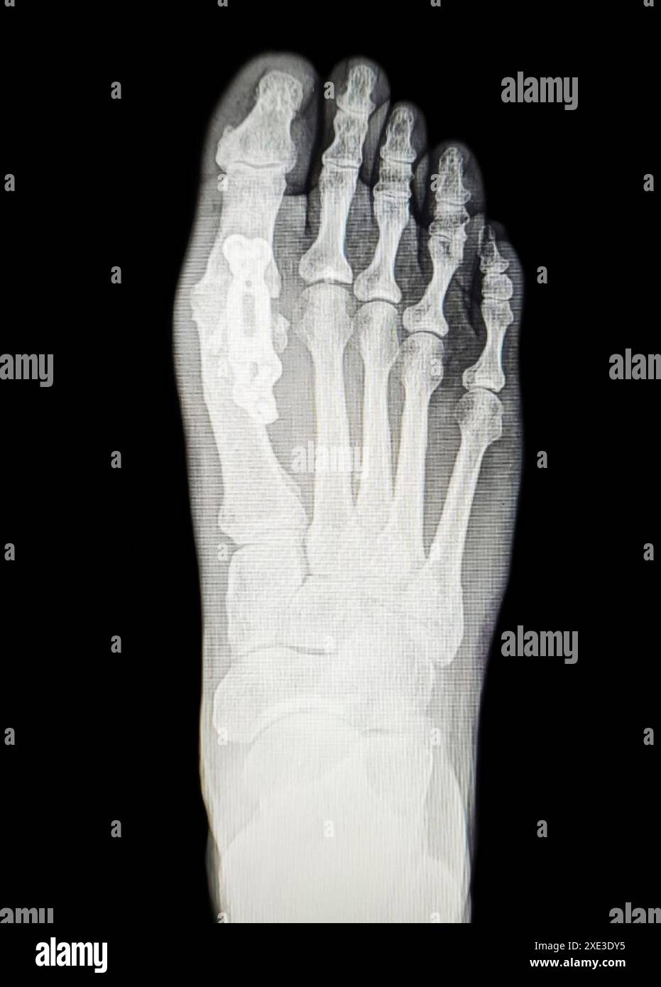 Arthrodesis xray hi-res stock photography and images - Alamy