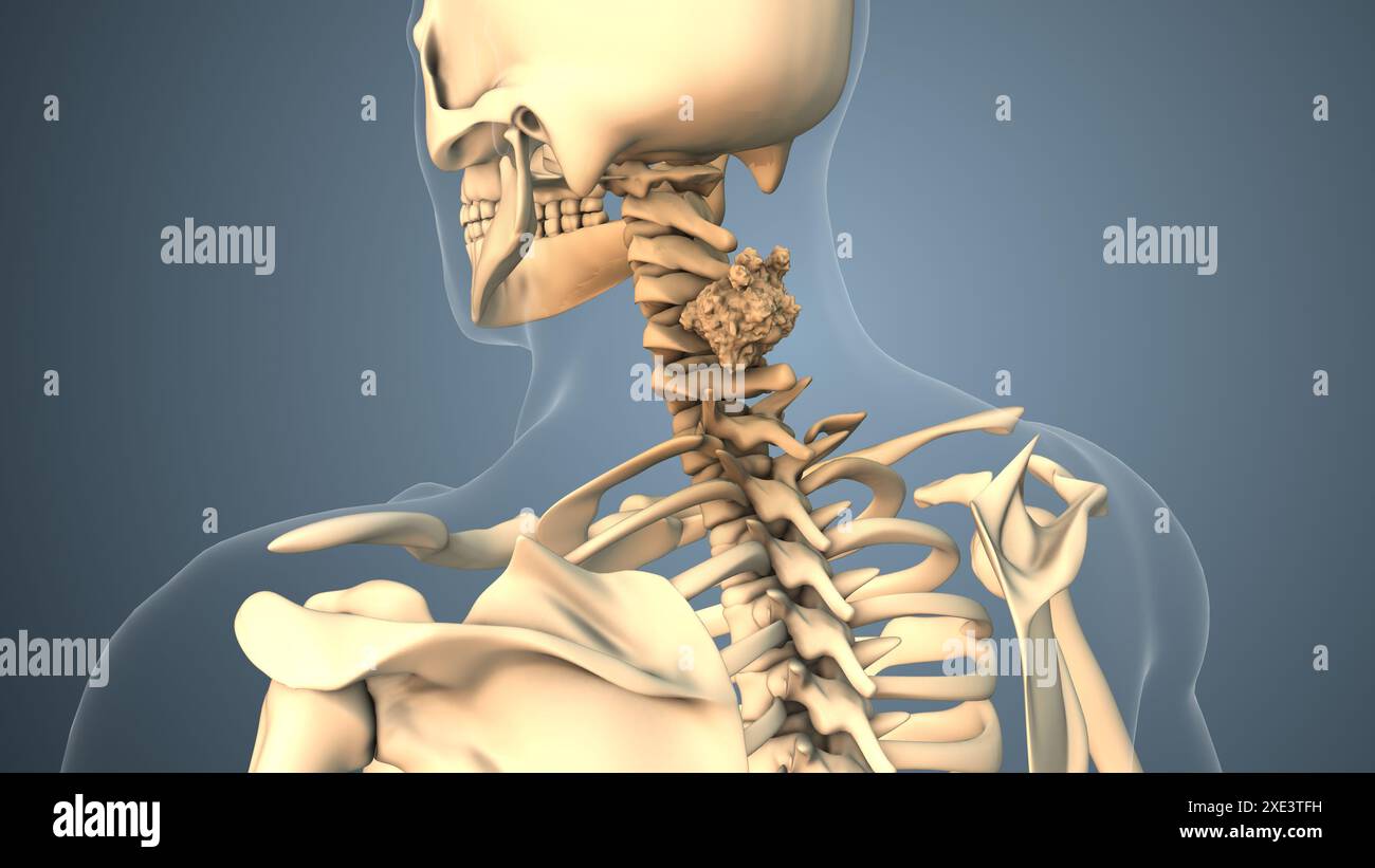 Cancer spreading along a neck bone or vertebral column Stock Photo - Alamy
