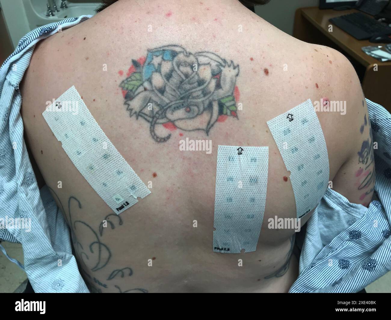 Editorial use only Allergy test strips on a patient's back. These ...