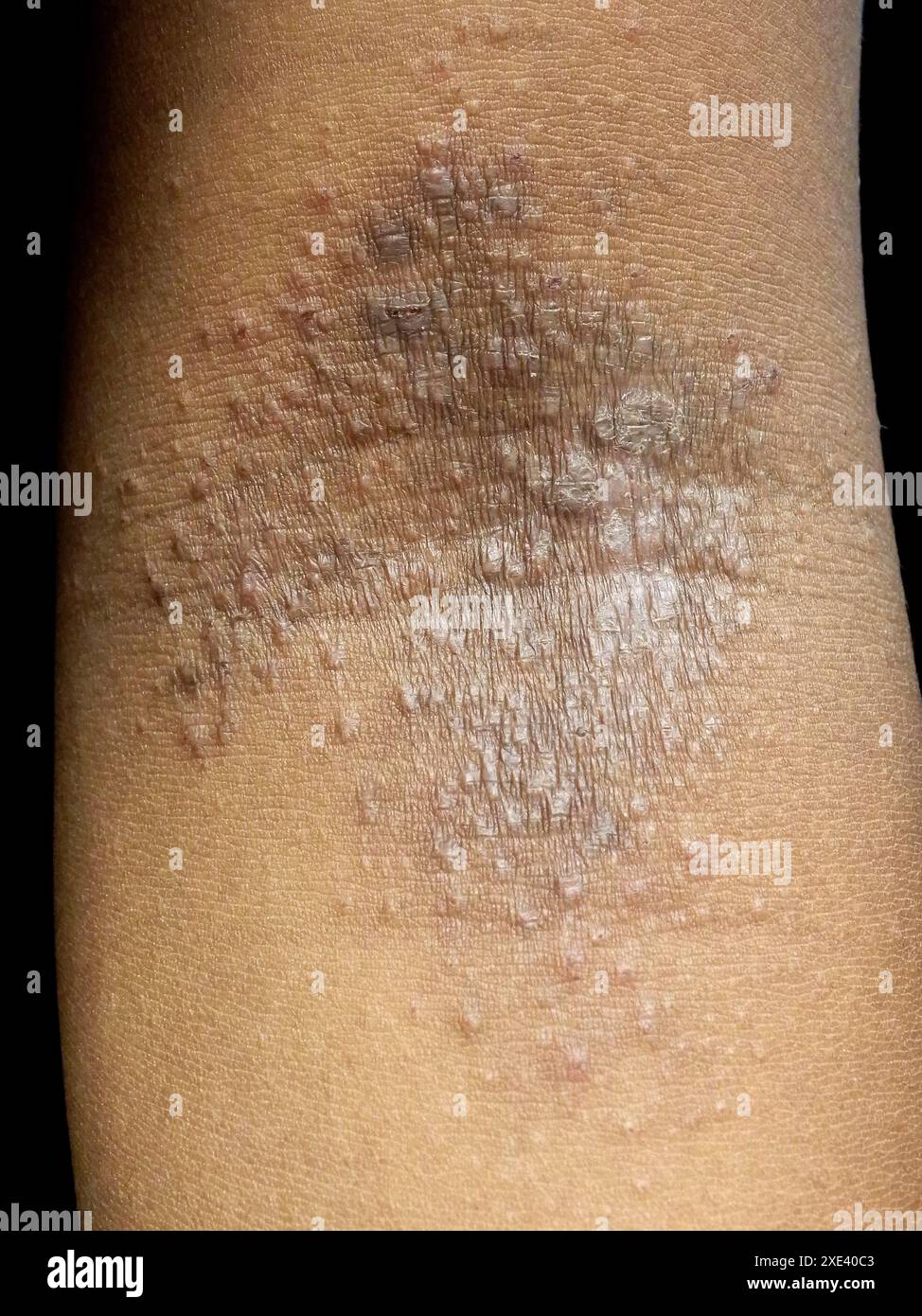 Not to be used for advertising or in a defamatory context Papular ...