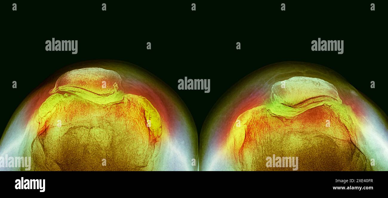 Coloured X-ray of the knees of a 73 year old female patient with severe ...