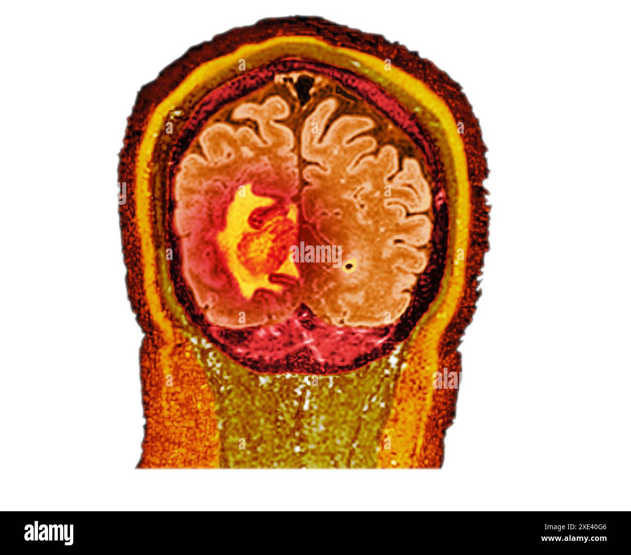 Coloured computed tomography (CT) scan of the head of a male patient with a glioblastoma (orange ...