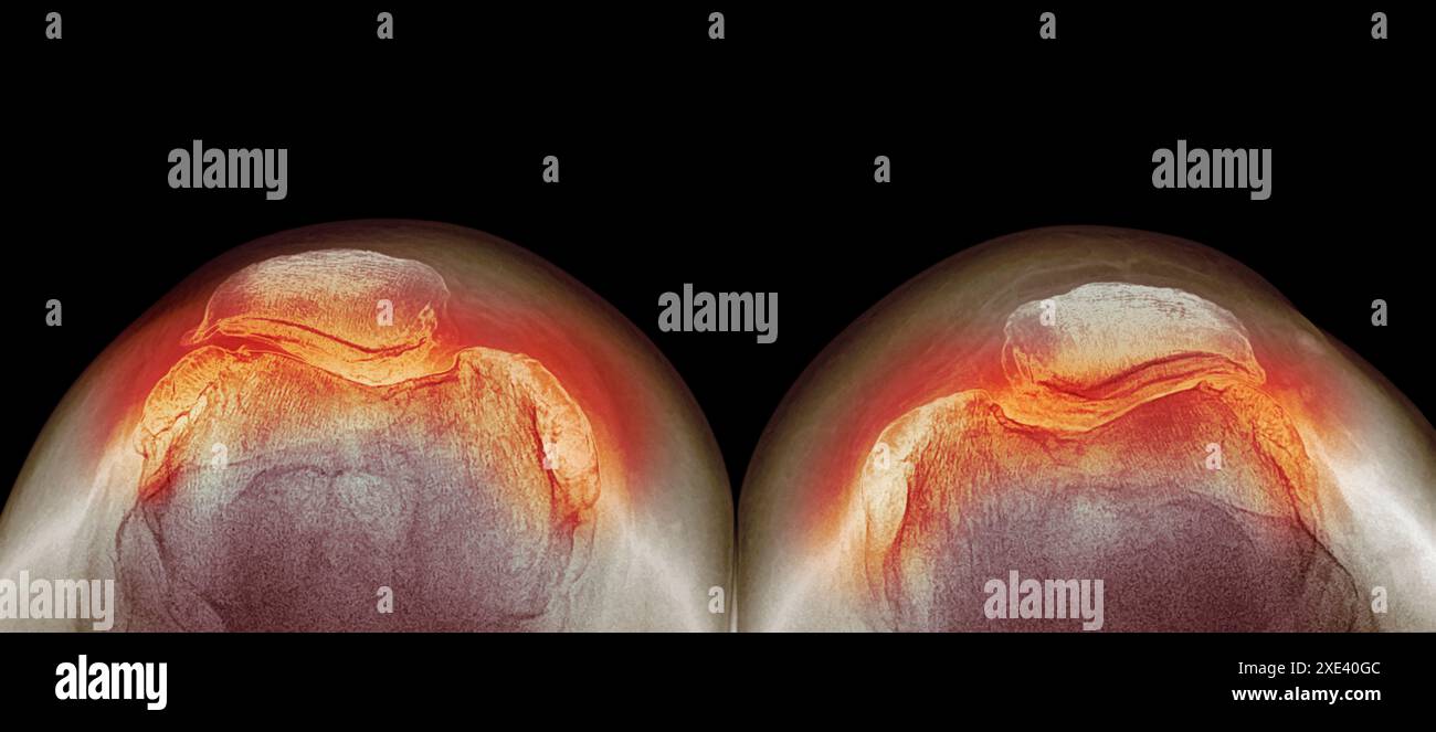 Coloured X-ray of the knees of a 73 year old female patient with severe ...