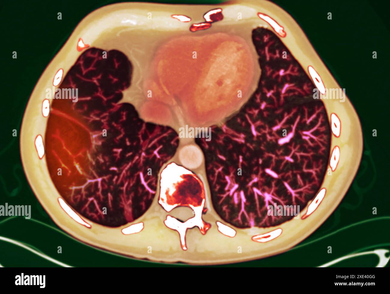 Coloured computed tomography (CT) scan of the chest of a 60 year old ...