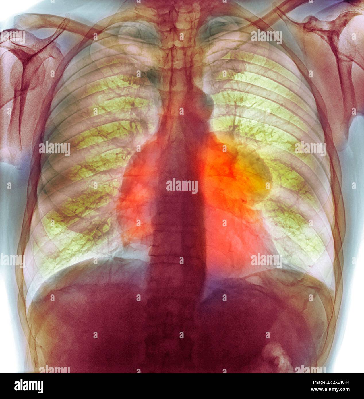 Coloured X-ray of a mediastinal mass (orange) in the chest of a 53 year ...