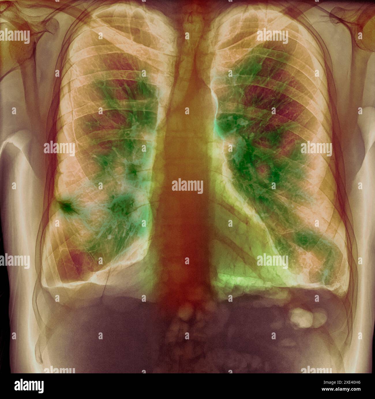 Coloured X-ray of the chest of a 60 year old male patient with ...