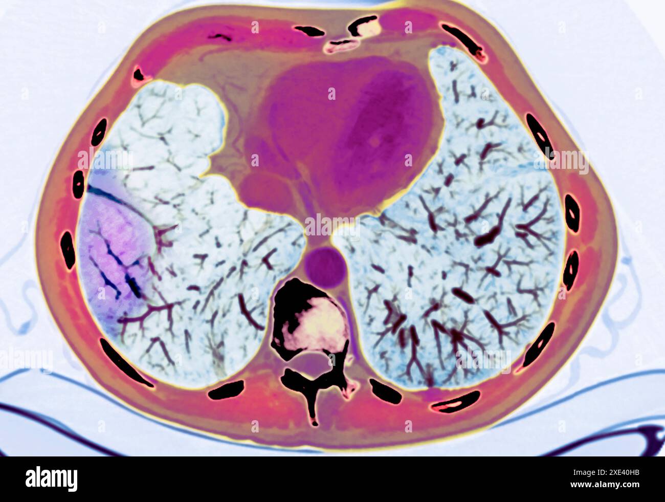 Coloured computed tomography (CT) scan of the chest of a 60 year old ...