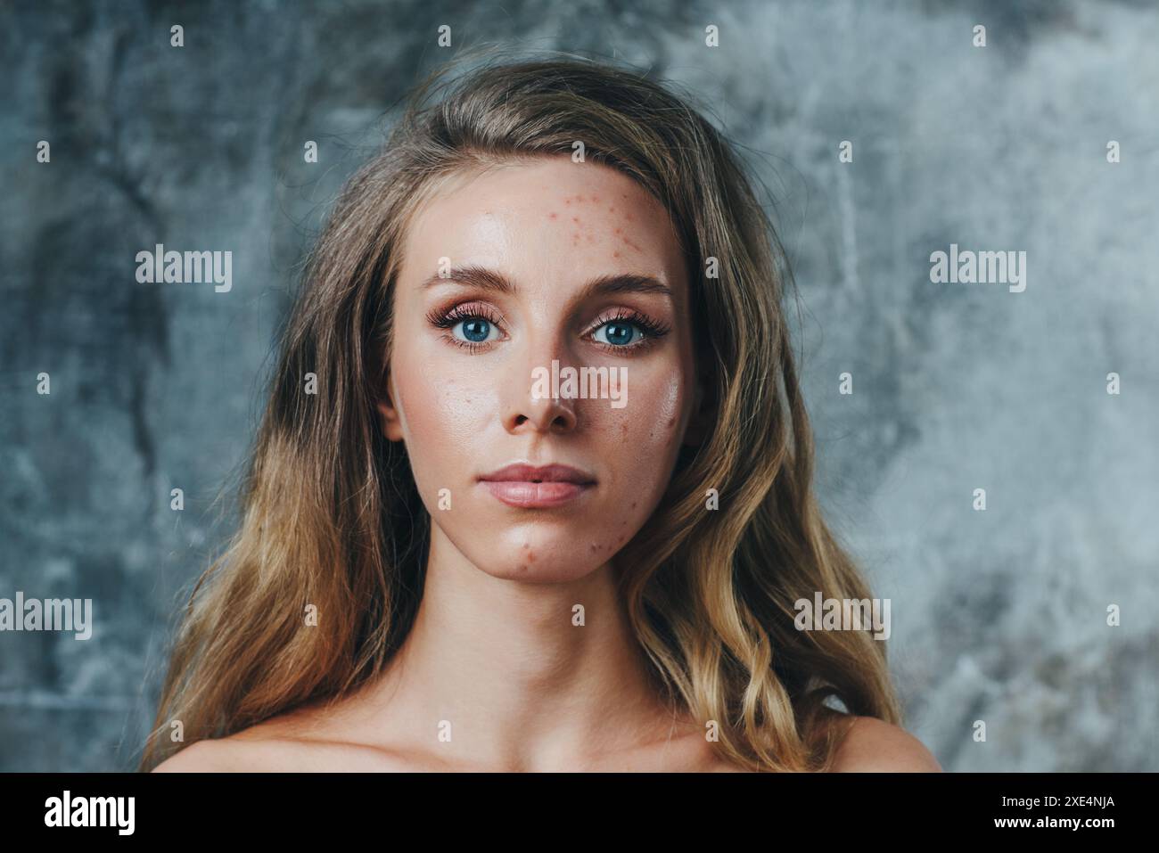Allergy and acne on face Stock Photo - Alamy