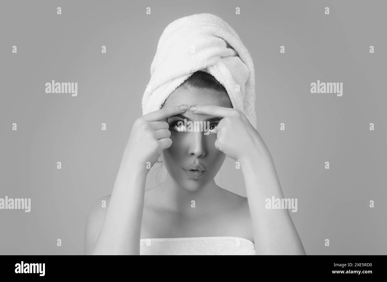 Woman squeeze out pimples on forehead. Acne and pimple on skin ...