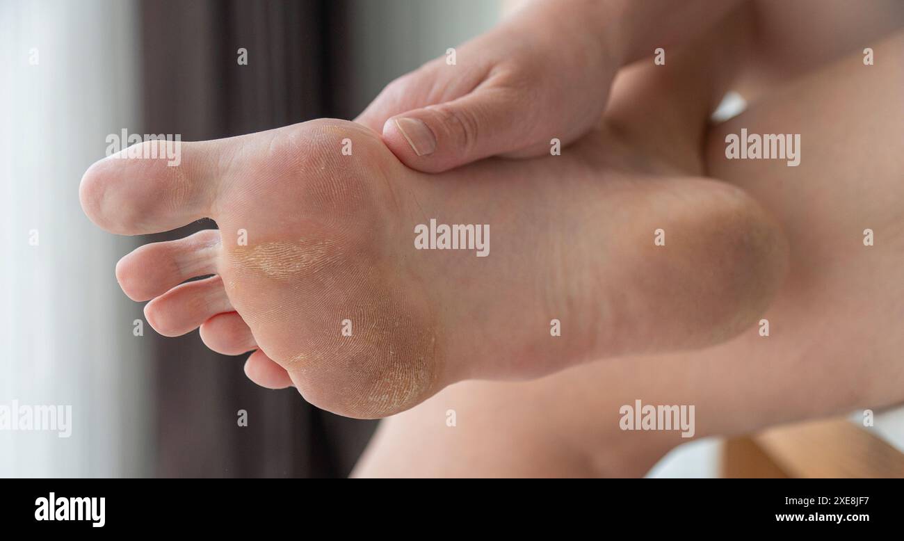 dirty and neglected feet, care and pedicure required Stock Photo - Alamy