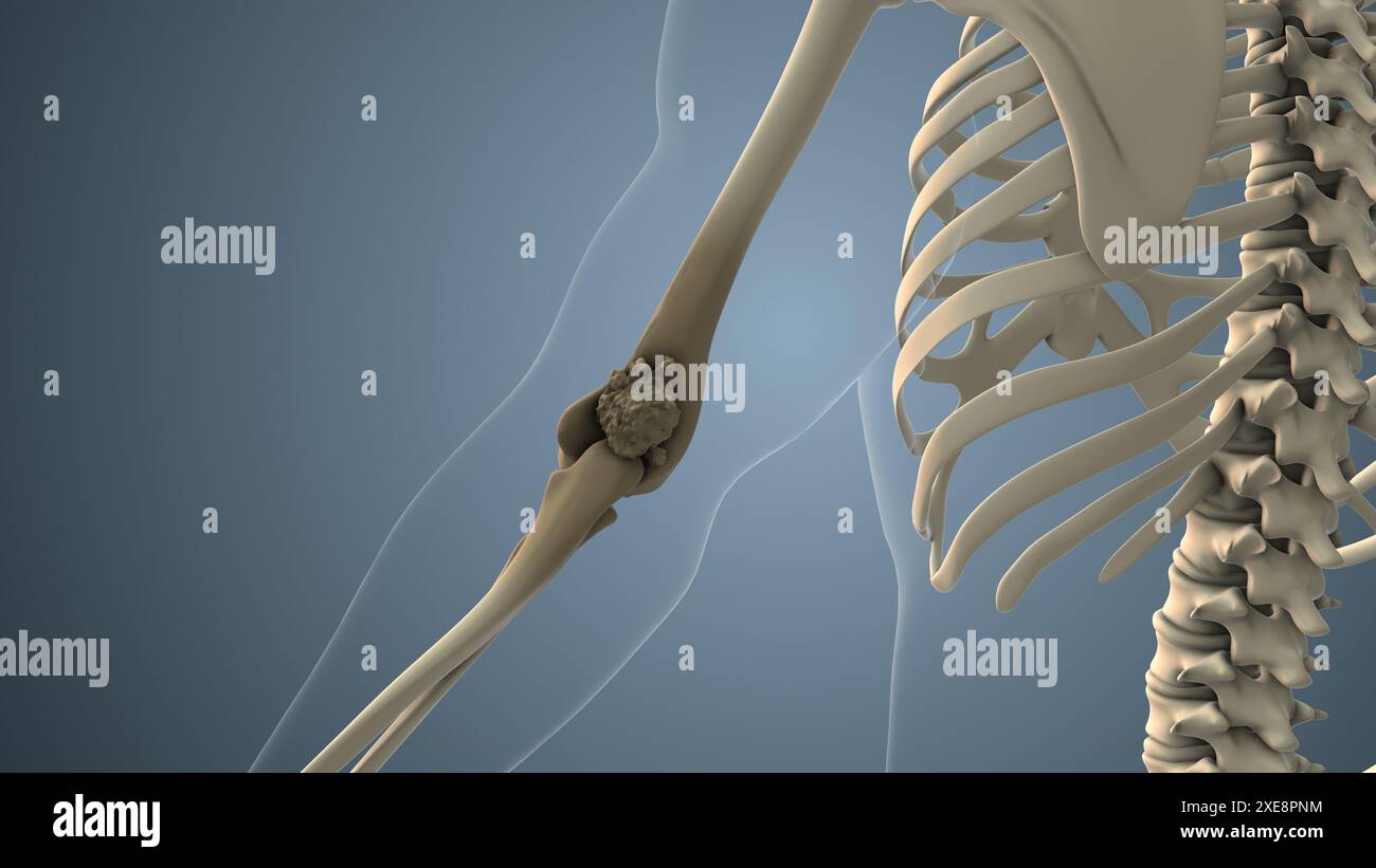 Cancer spreading along a elbow bone Stock Photo - Alamy