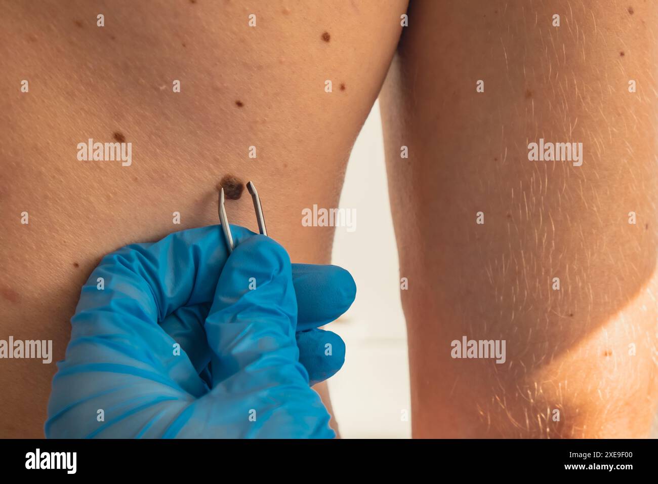 Doctor in medical gloves examining man skin mole for size ...