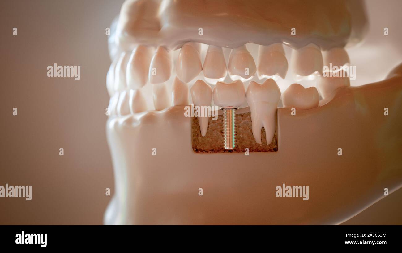 Dental Implant Procedure 3D Rendering Stock Photo - Alamy