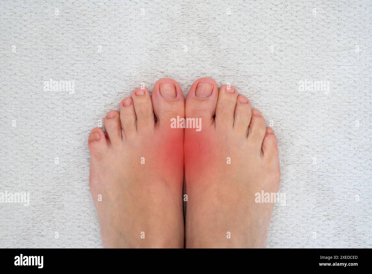 Feet disease Rheumatism and gout. Painful gout inflammation on big toe ...