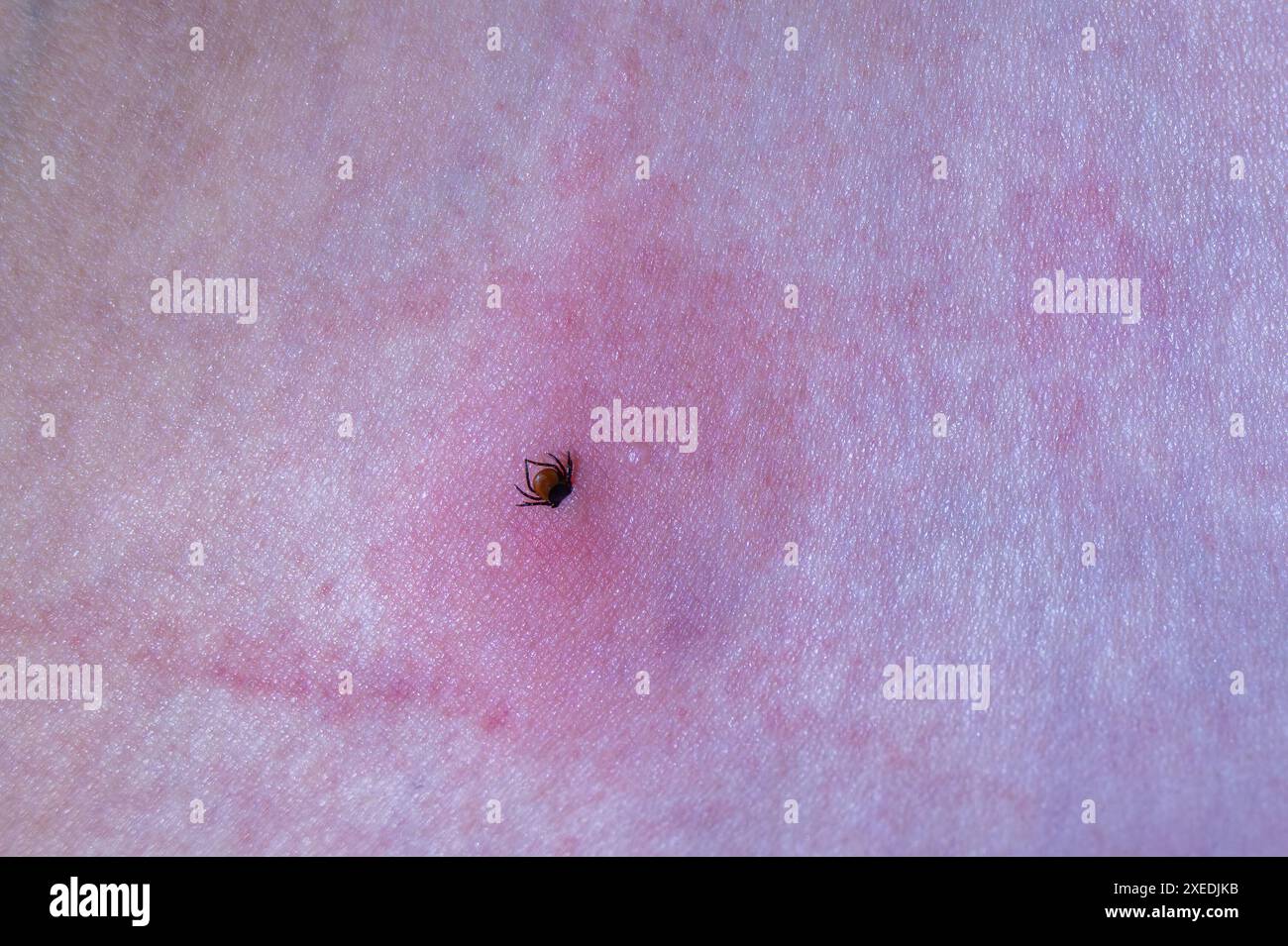 Blood-sucking ectoparasites - A tick full of blood on irritated human ...