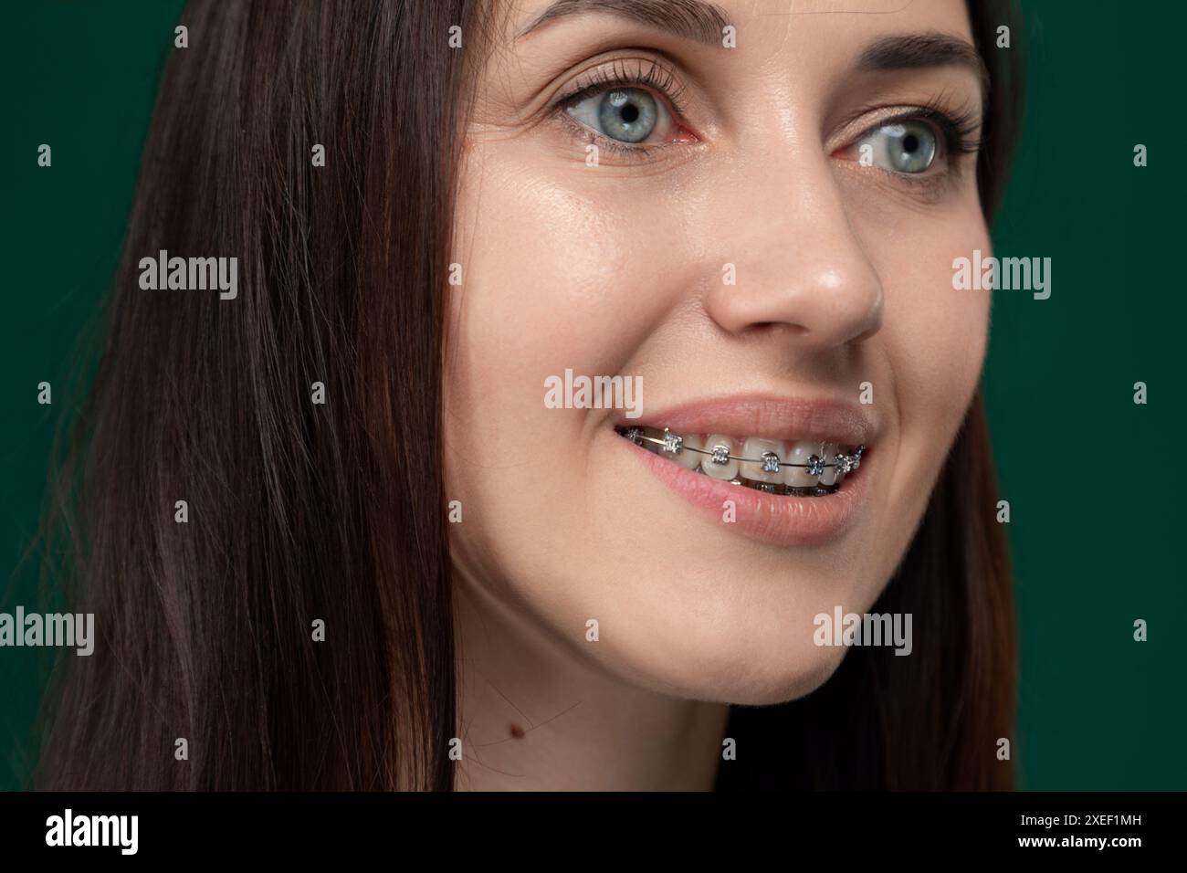 Woman With Braces Smiling Stock Photo - Alamy