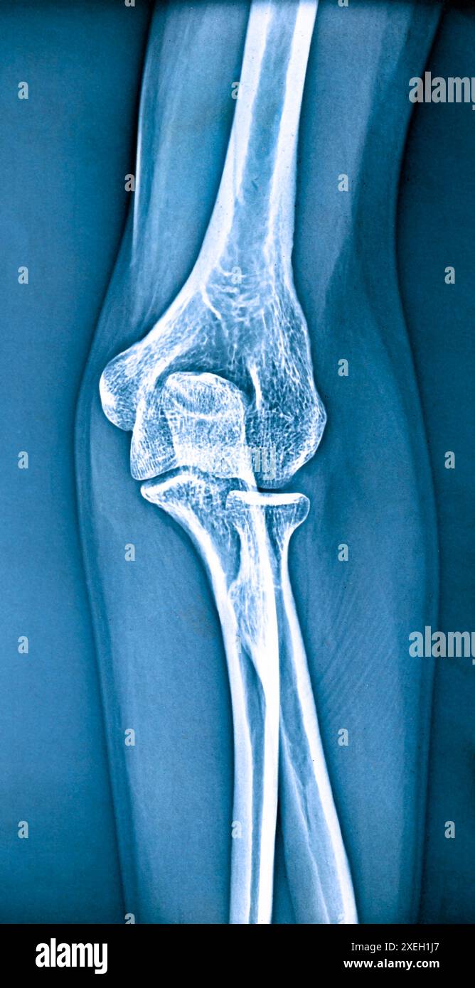 X-ray arm bend Stock Photo - Alamy