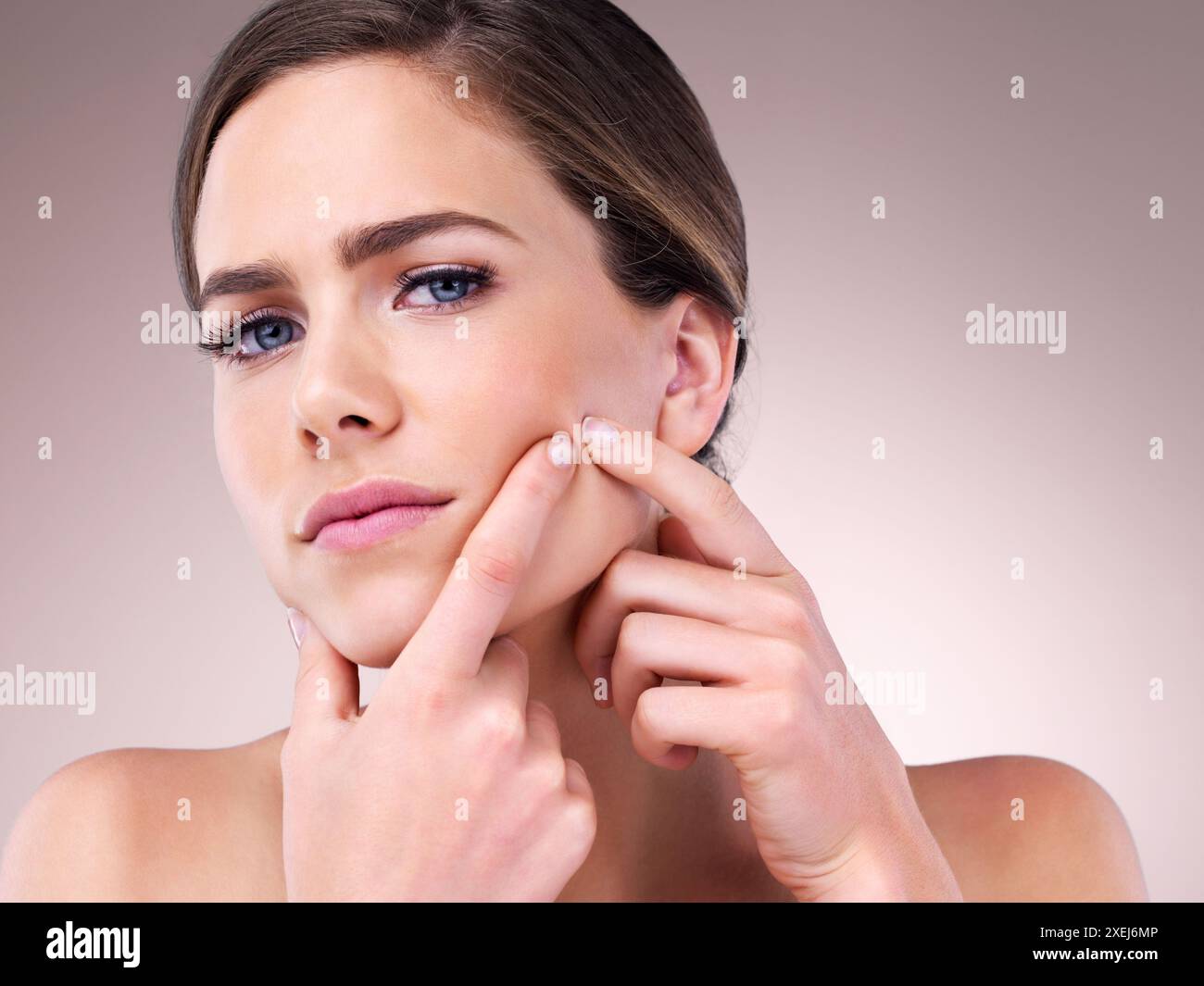 Portrait, girl and skincare with acne breakout, cosmetics and wellness ...