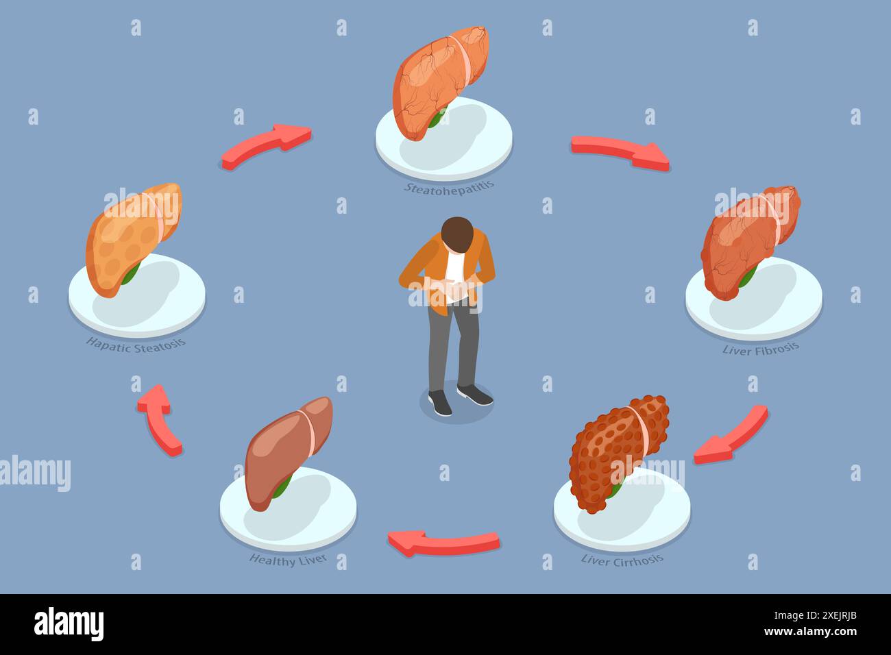 3D Isometric Flat Conceptual Illustration of Stages Of Liver Damage ...