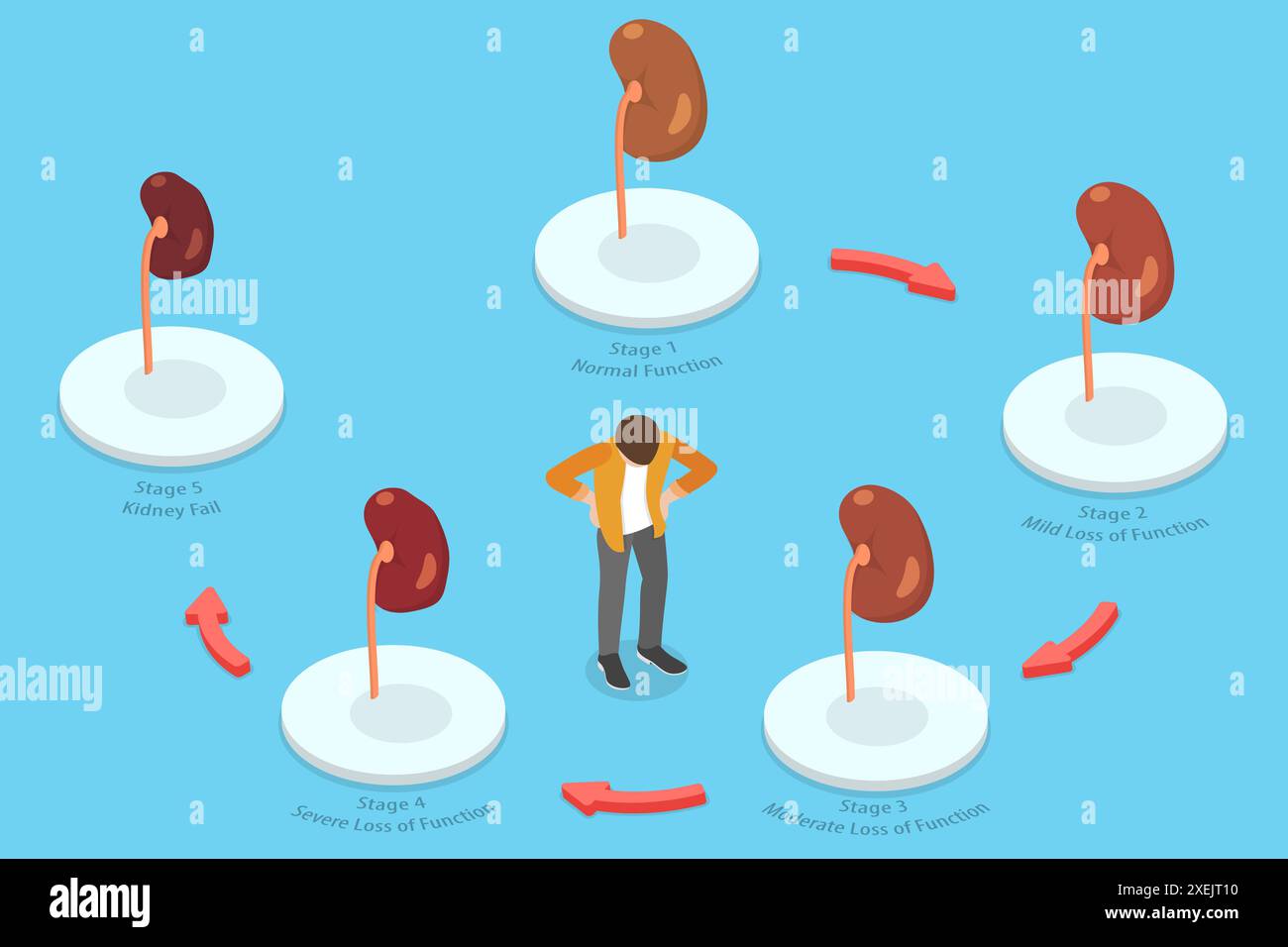 3D Isometric Flat Conceptual Illustration of Kidney Disease, Stages of ... 3D Isometric Flat Conceptual Illustration of Kidney Disease, Stages of ...
