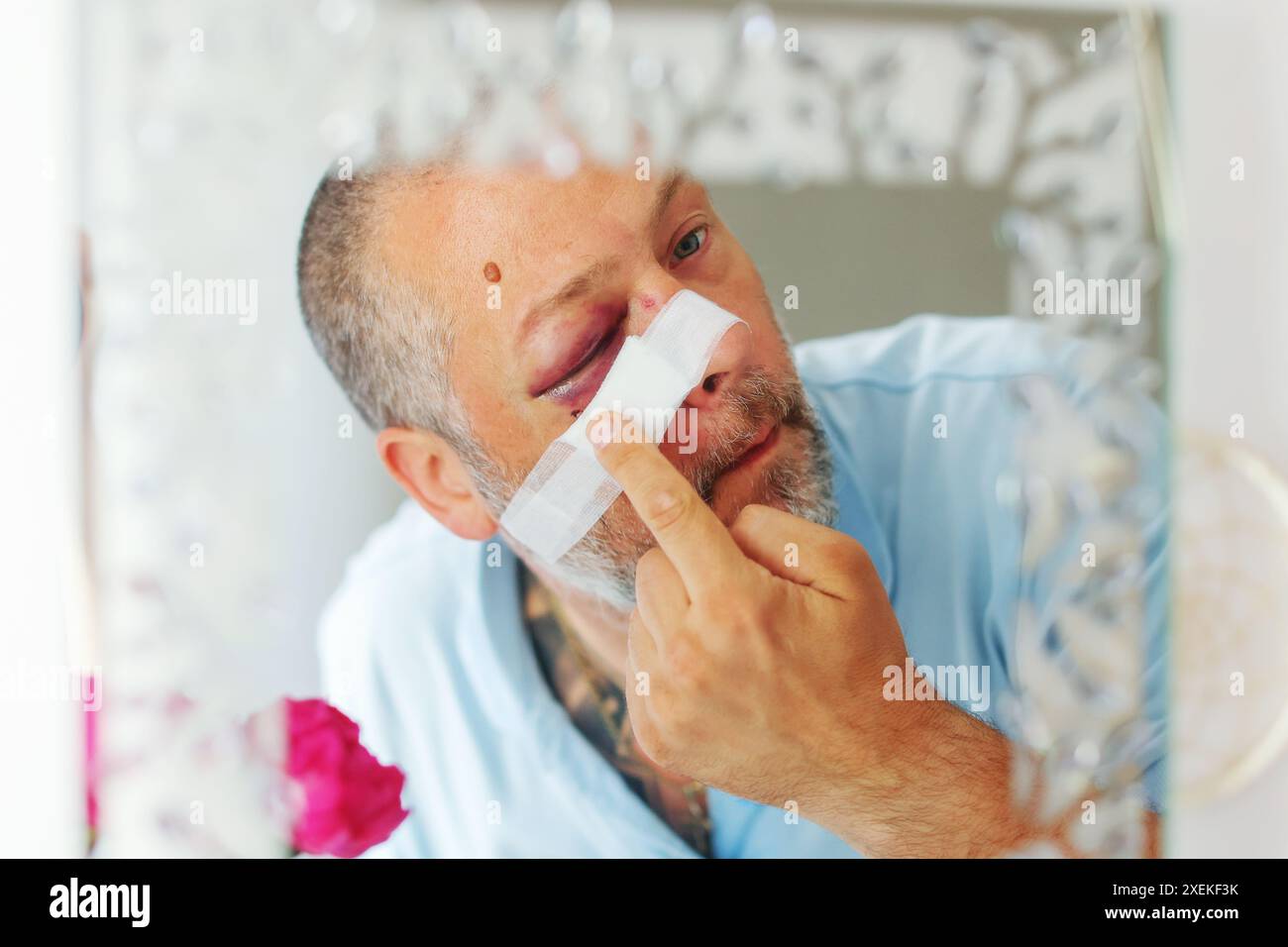 white man with a purple black eye and head injury - eye closed. he ...