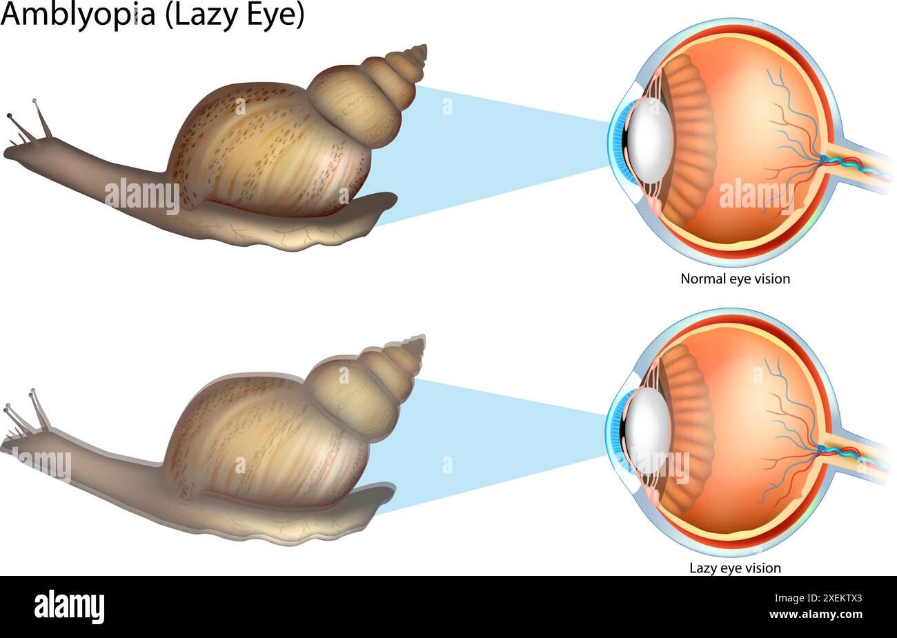 Amblyopia or Lazy Eye. Lazy eye vision and Normal eye Stock Vector ...