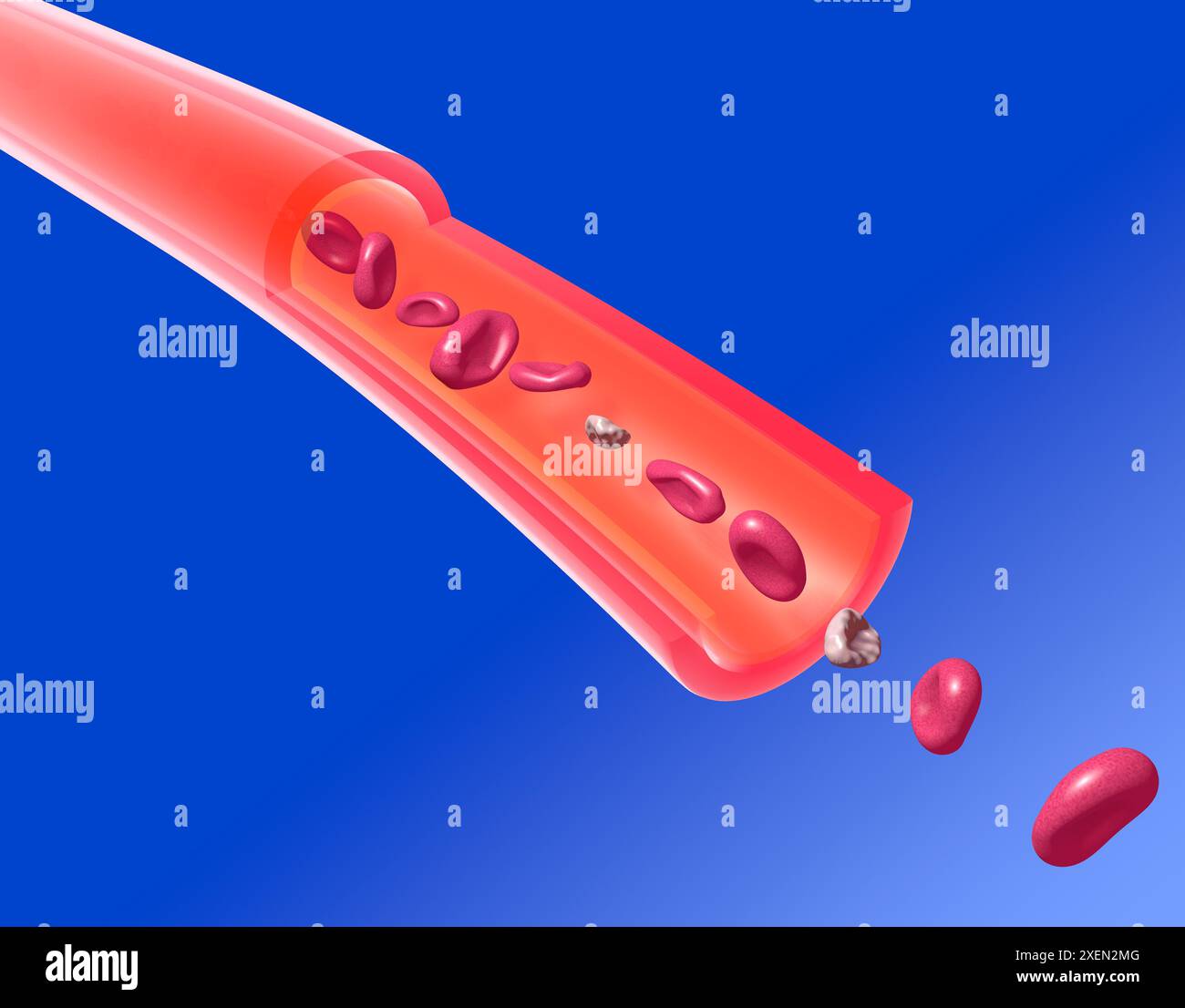 Anatomical 3D illustration of incompetent artery with fat obstruction. Movement of red blood ...