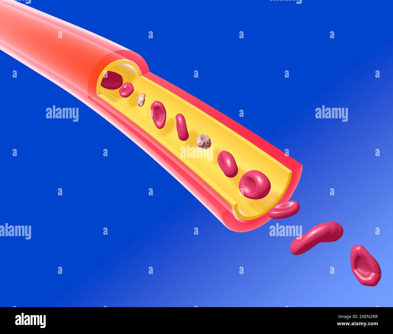 Anatomical 3D illustration of incompetent artery with fat obstruction ...