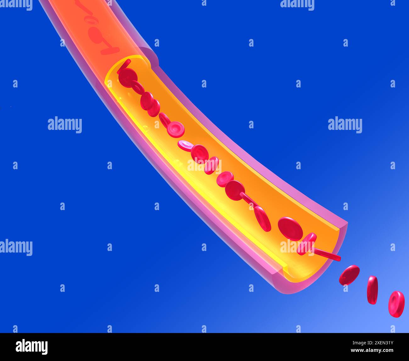 Anatomical 3D illustration of artery with fat stuck to the walls ...