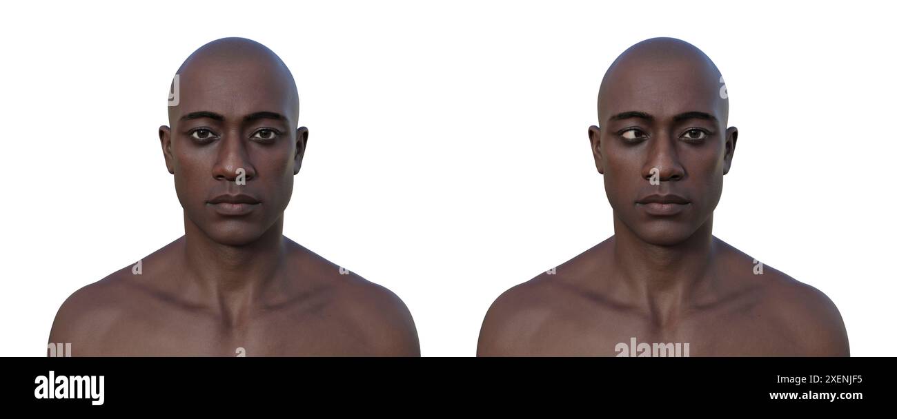 Illustration of a man with esotropia showing inward eye misalignment ...