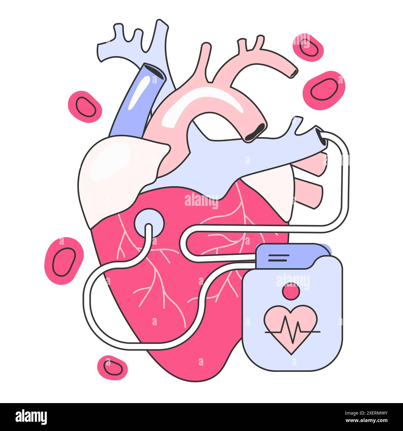 Artificial cardiac pacemaker. Medical device that generates electrical ...