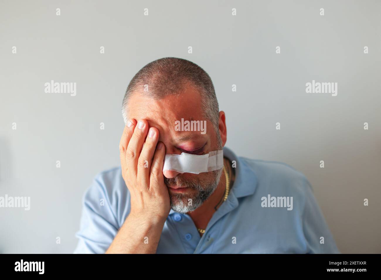 eye injury, man is very sad with black eye. man after accident or fight ...