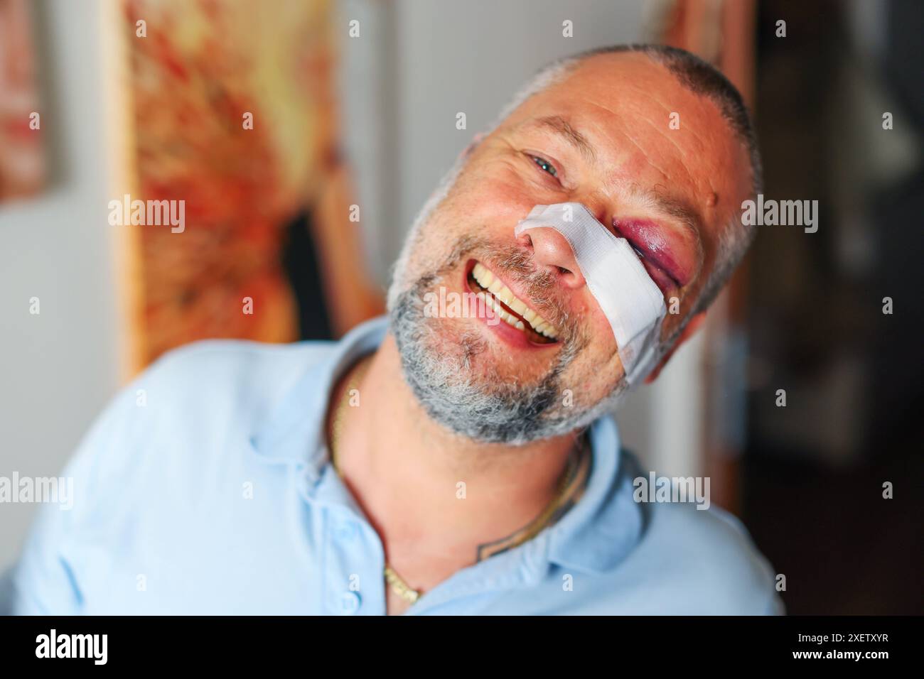 eye injury, man try to joke with black eye. man after accident or fight ...