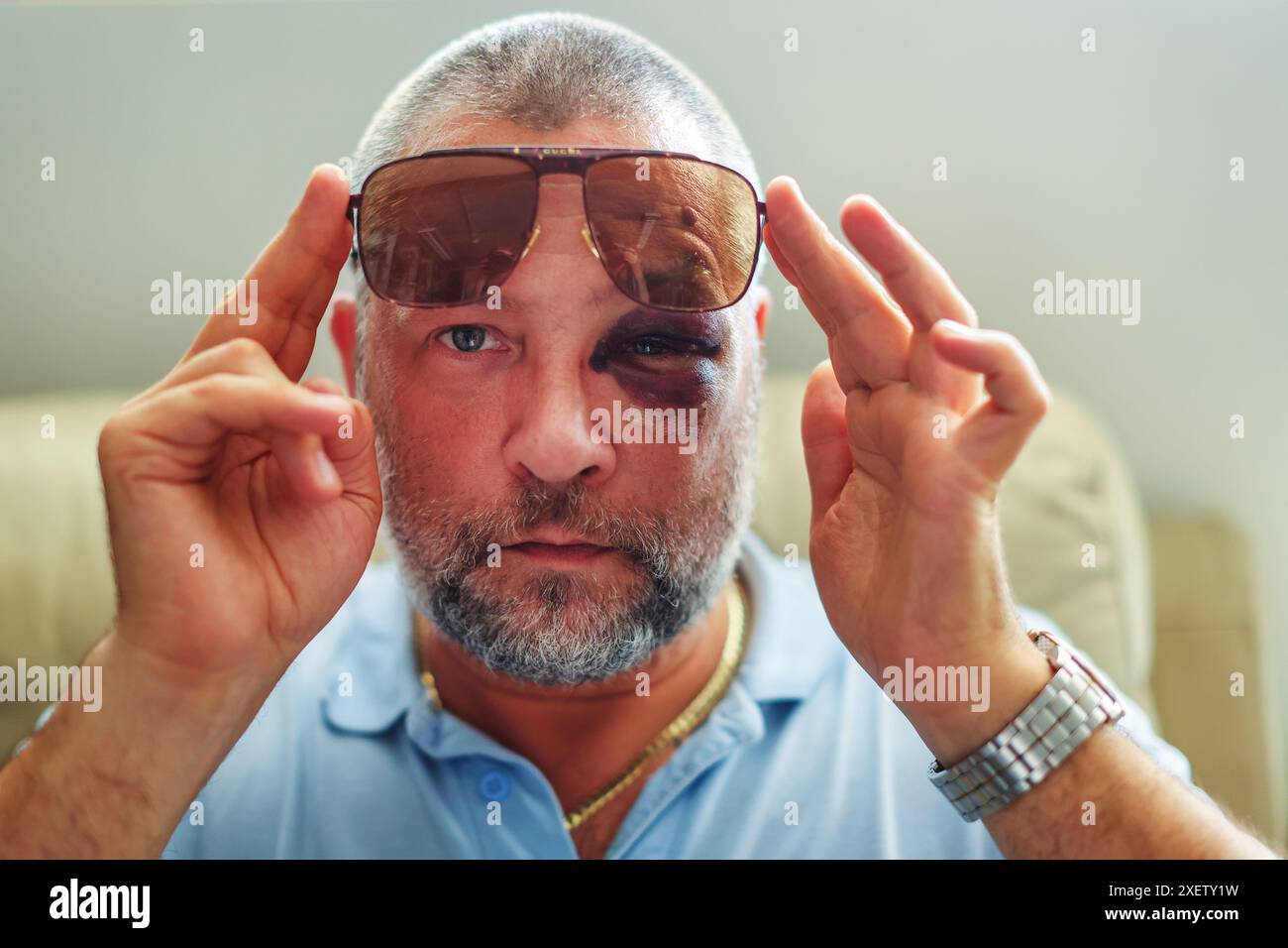 eye injury, man use sunglasses with black eye. man after accident or ...