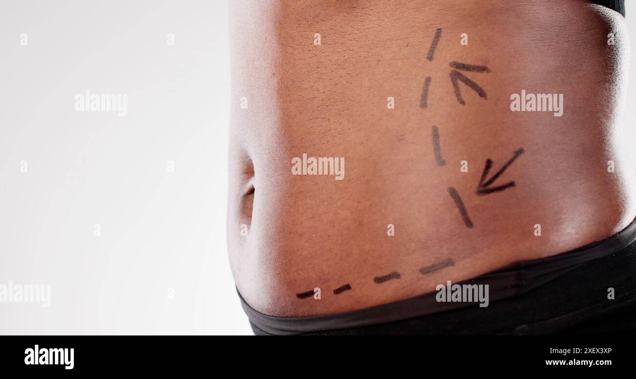 Tummy tuck black hi-res stock photography and images - Alamy