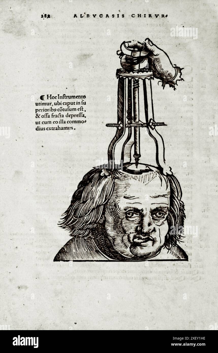 Medieval trepanation of the skull hi-res stock photography and images ...