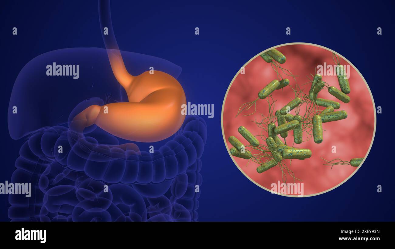 Stomach infection caused by Helicobacter pylori Stock Photo - Alamy