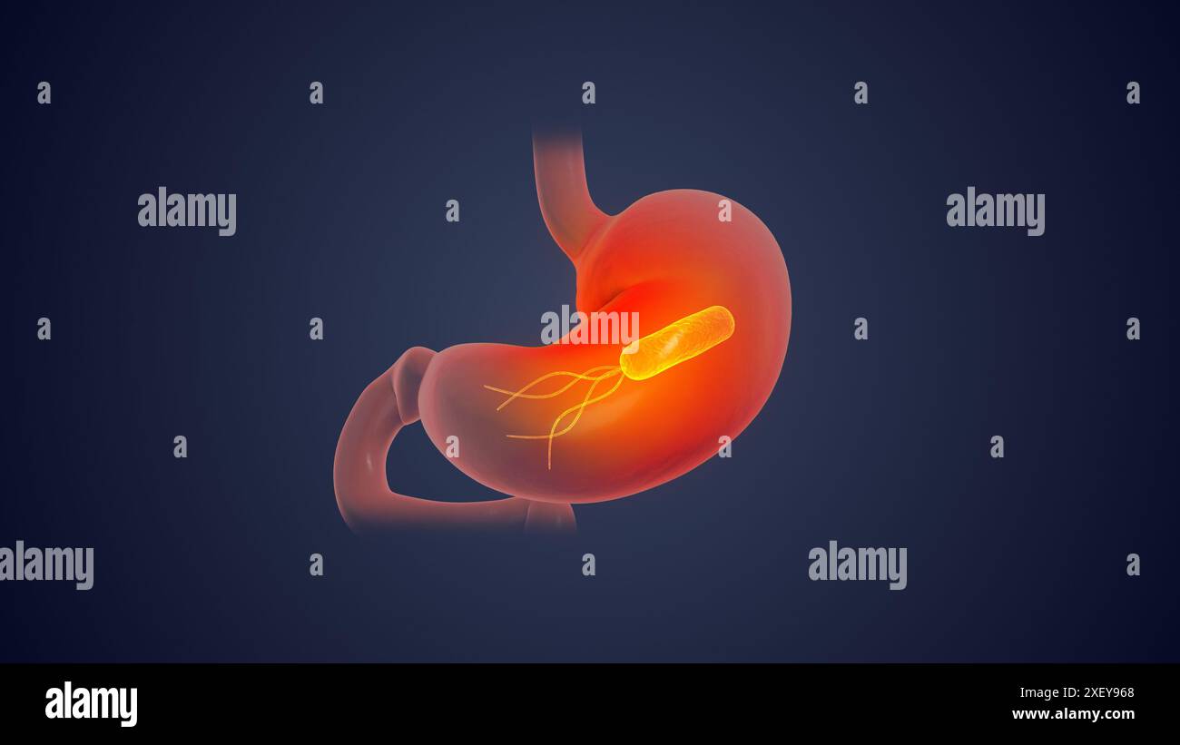 Human stomach with peptic ulcer hi-res stock photography and images - Alamy