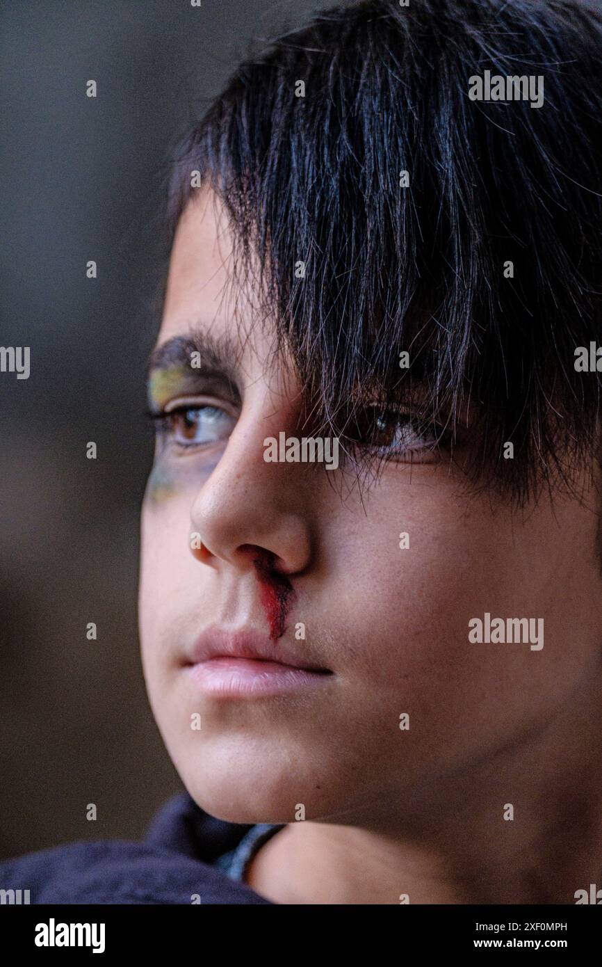 Boy bleeding nose hi-res stock photography and images - Alamy