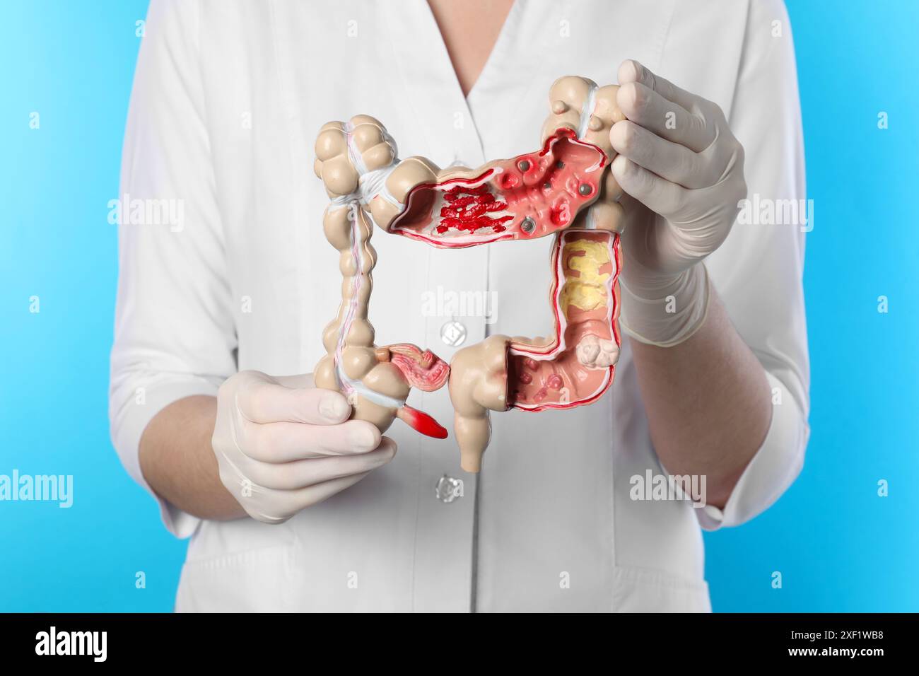 Doctor with model of large intestine on light blue background, closeup ...