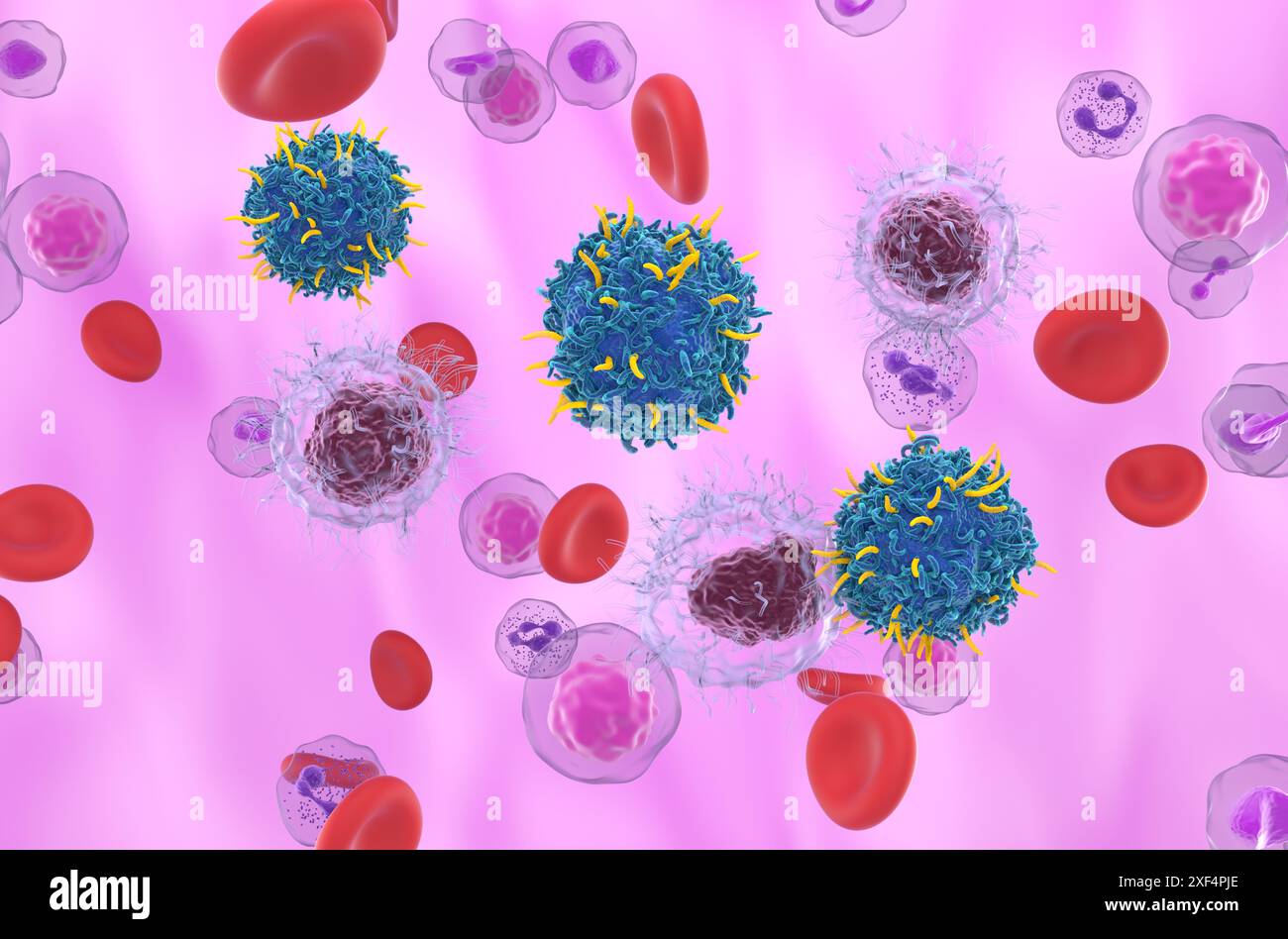 Chronic lymphocytic leukemia hi-res stock photography and images - Alamy