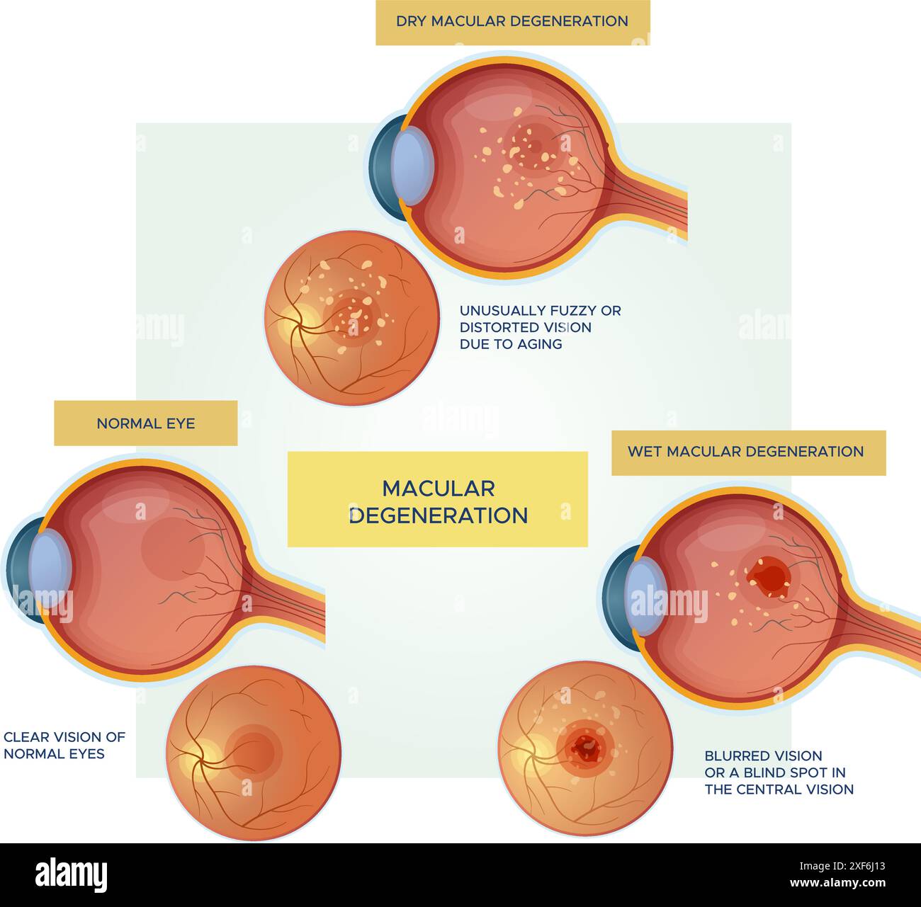 Normal Eyes vs Dry / Wet Macular Degeneration - Stock Illustration as ...