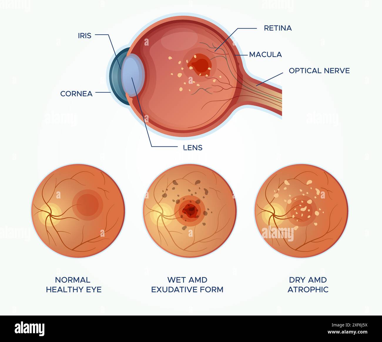 Understanding Macular Degeneration Healthy Eyes vs Wet and DRY AMD ...