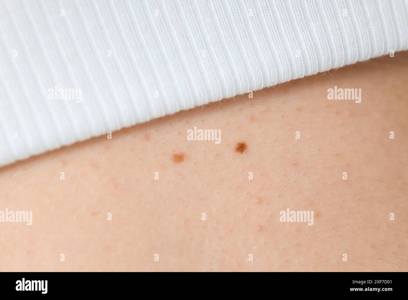 Different mole hi-res stock photography and images - Alamy