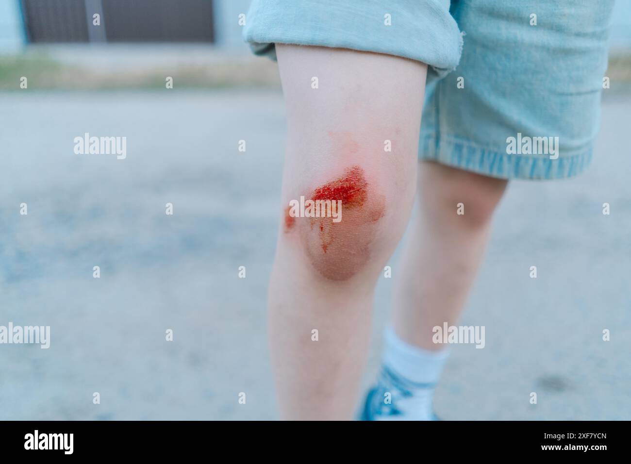 Skin scrape knee child hi-res stock photography and images - Alamy