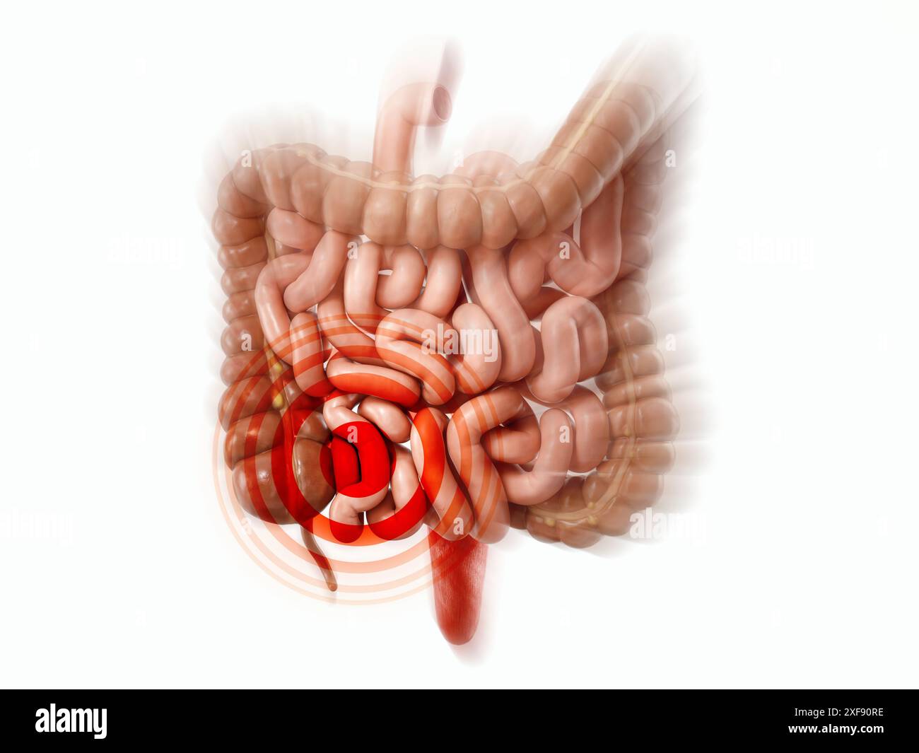 3d illustration of human internal organ - intestine. Sick intestine ...