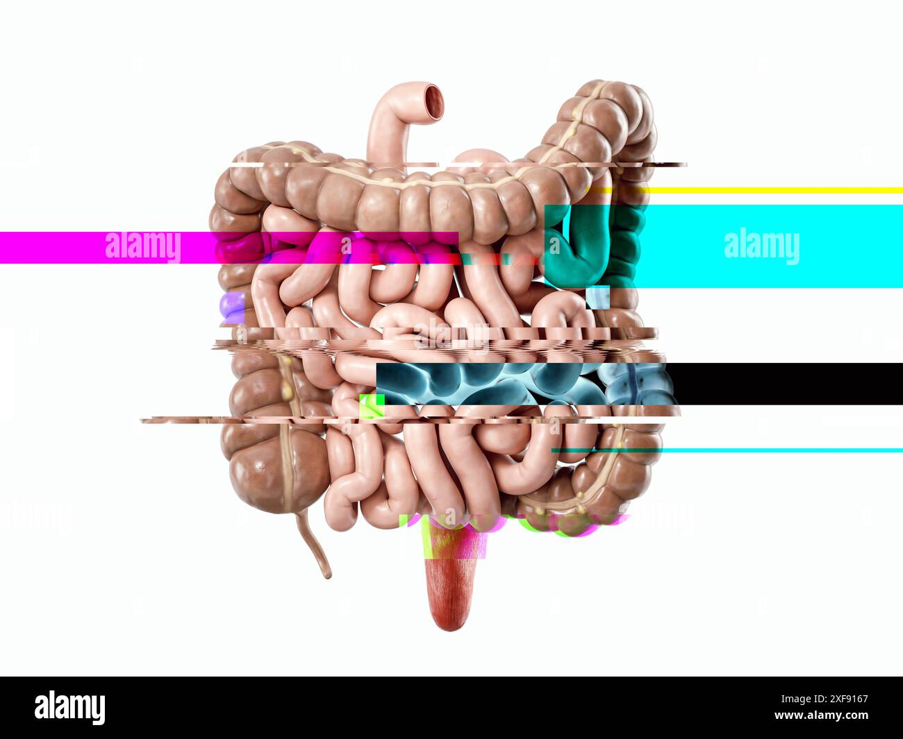 3d illustration of human internal organ intestine, failure concept ...